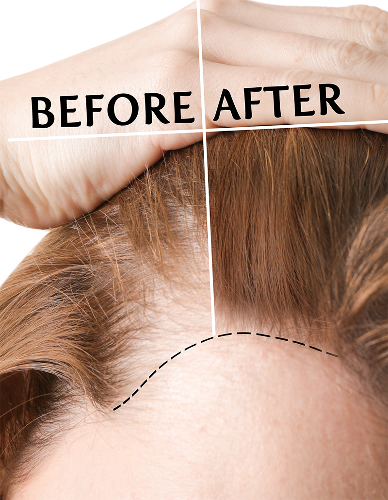 Slide De Foliculo Capilar Anatomía Microscópica Del Folículo Piloso